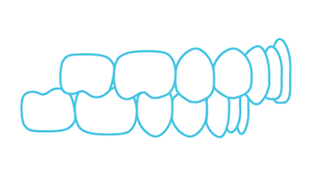 Ormco - Spark™ - Innovative & Advanced Clear Aligner System