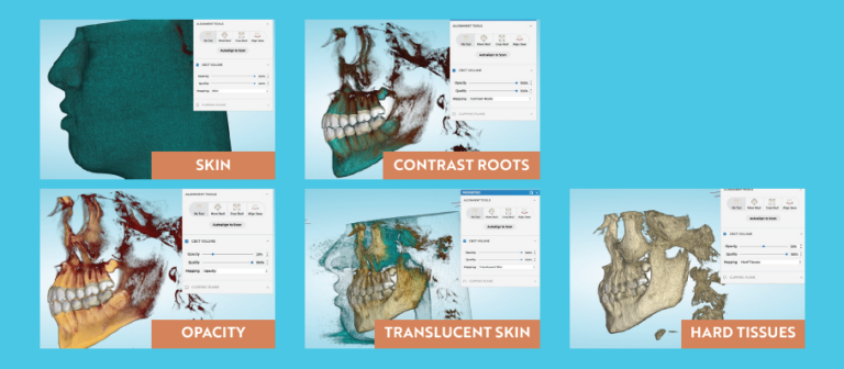 Ormco - Spark™ - Innovative & Advanced Clear Aligner System