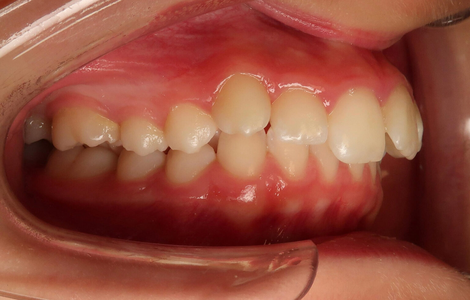 Treatment of a growing patient with class II