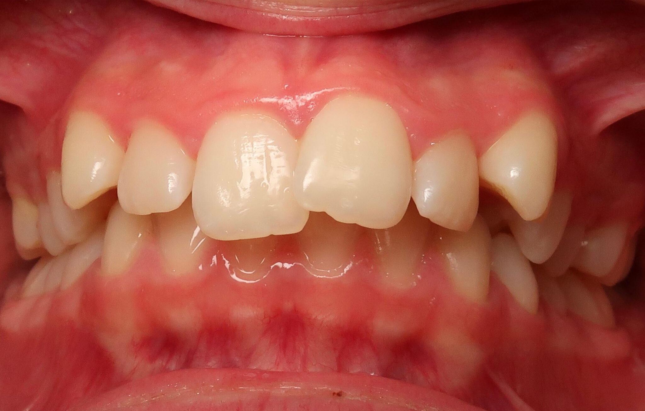 Treatment of a growing patient with class II