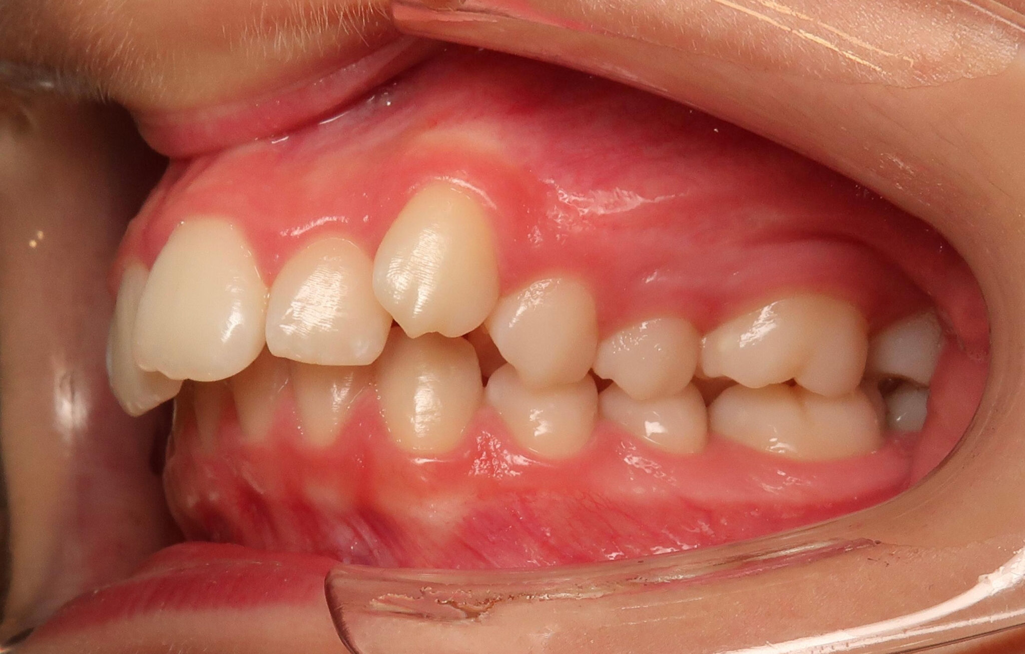 Treatment of a growing patient with class II