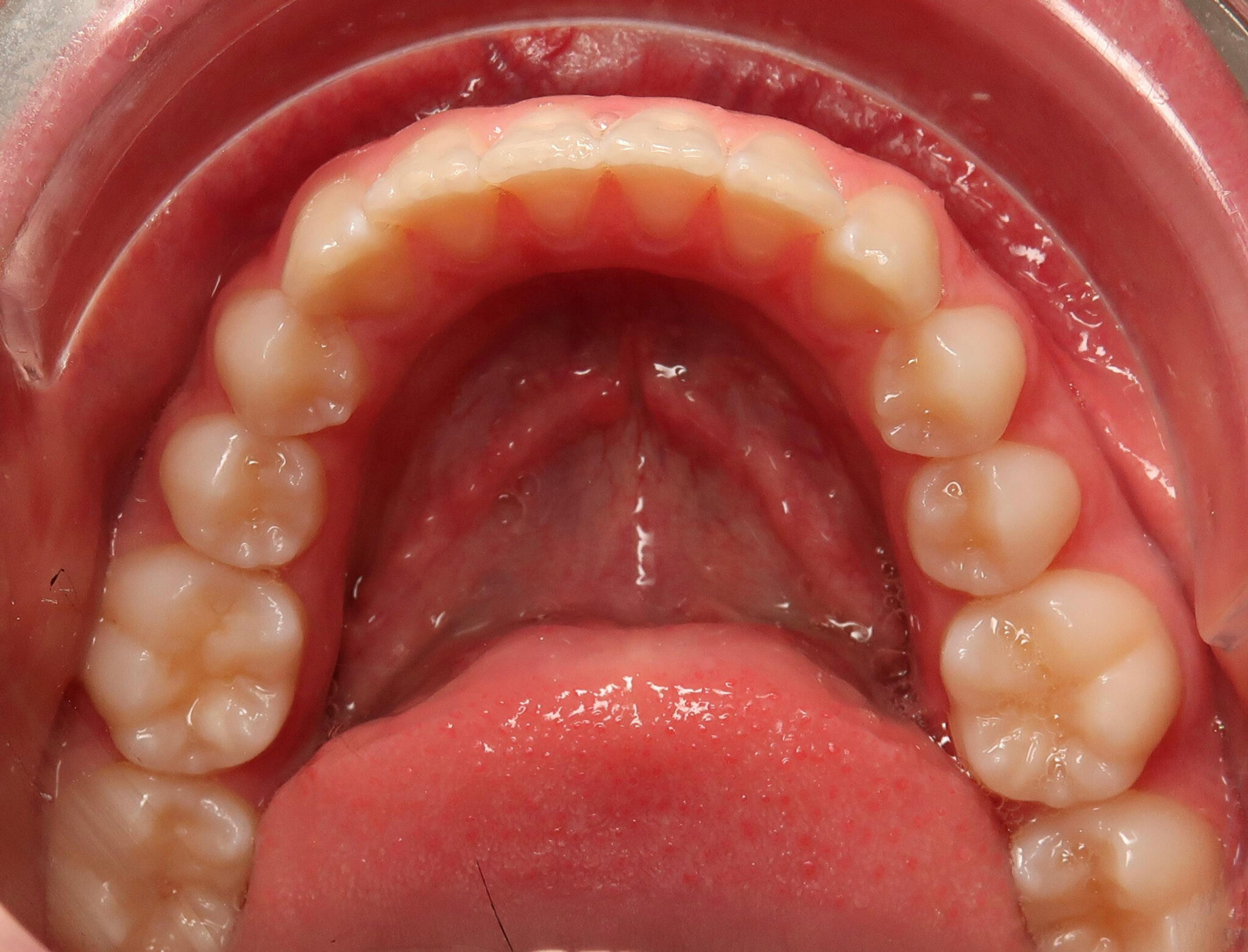 Treatment of a growing patient with class II