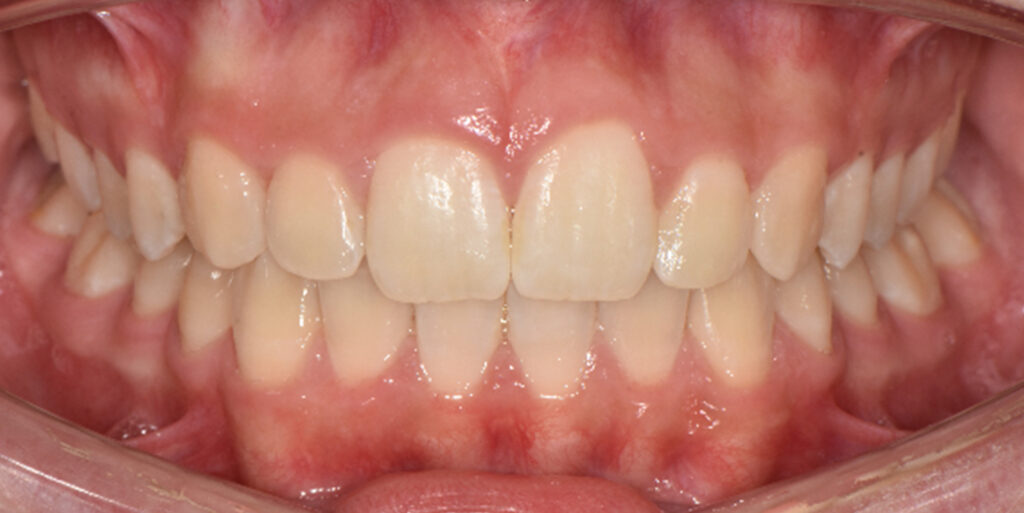 Class II sub-division 2 malocclusion with significant maxillary and ...