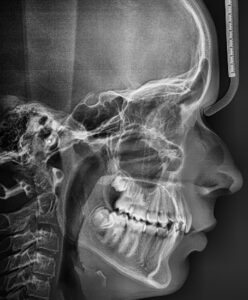 Class II sub-division 2 malocclusion with significant maxillary and ...
