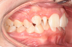 Class II sub-division 2 malocclusion with significant maxillary and ...