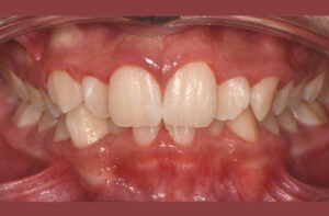 Class II sub-division 2 malocclusion with significant maxillary and ...