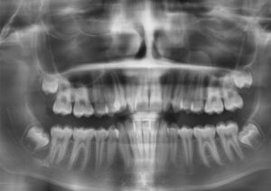 Class II sub-division 2 malocclusion with significant maxillary and ...