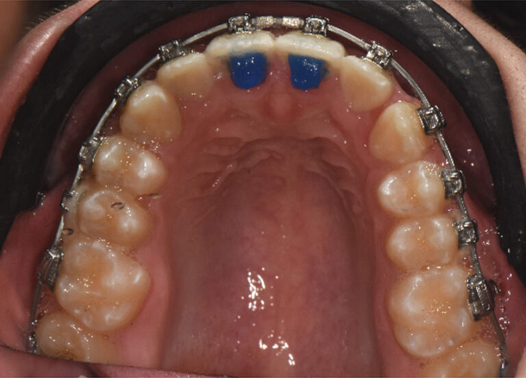 Class II sub-division 2 malocclusion with significant maxillary and ...
