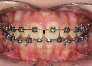 Class II sub-division 2 malocclusion with significant maxillary and ...