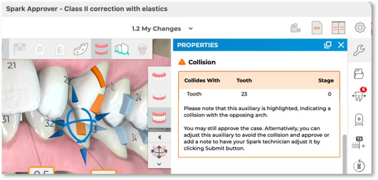 Ormco - Spark™ Releases - Latest Updates on Spark Aligners