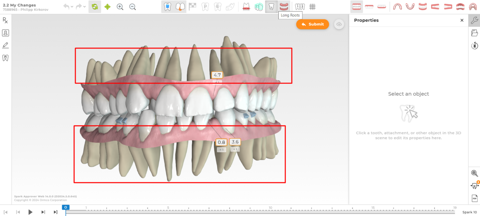 Ormco - Spark™ Releases - Latest Updates on Spark Aligners