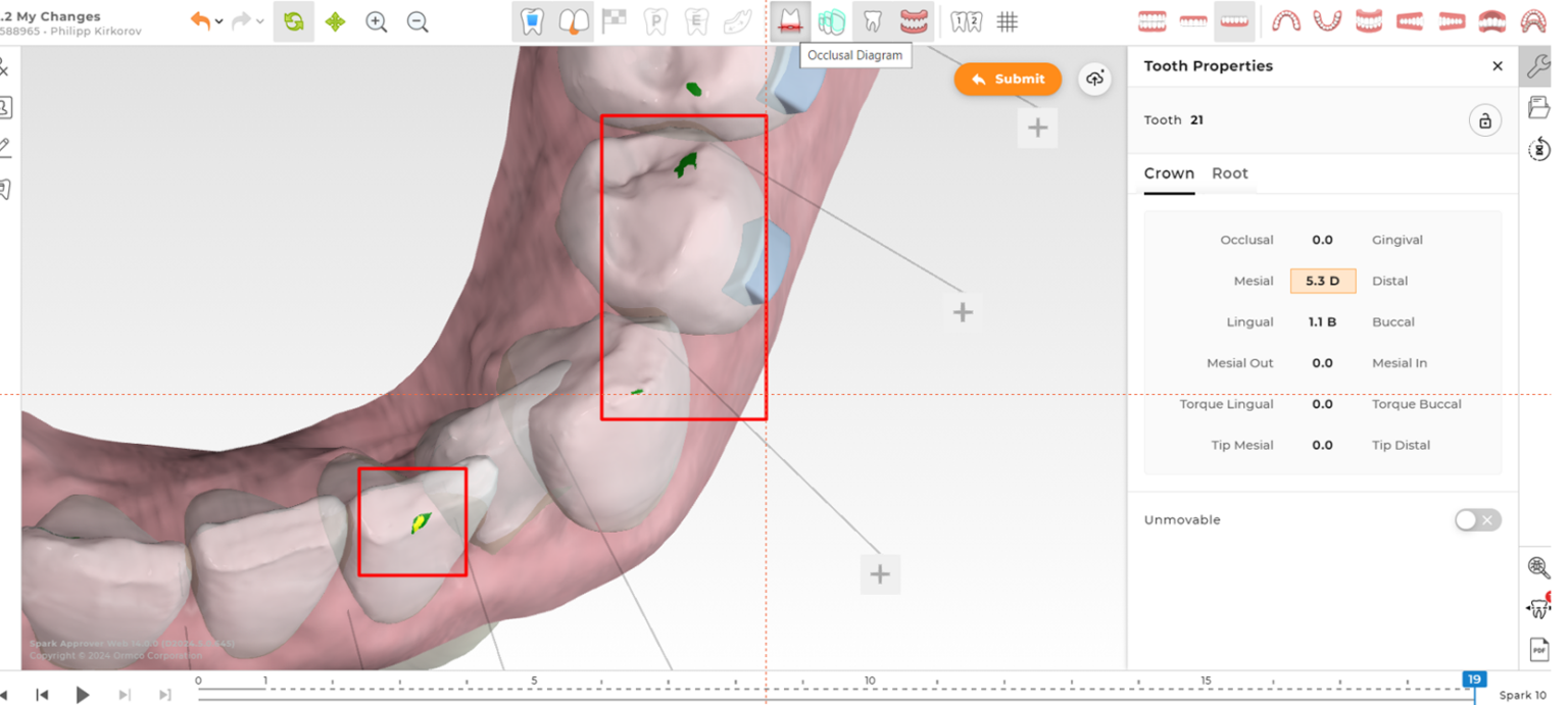 Ormco - Spark™ Releases - Latest Updates on Spark Aligners