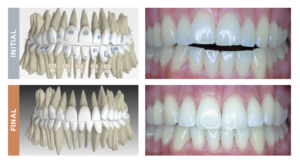 Spark™ - Doctor Site - Innovative & Advanced Aligner System