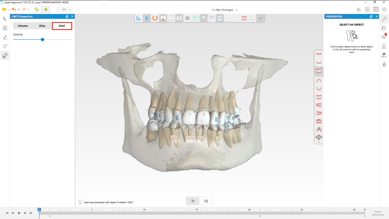 Ormco - Spark™ Releases - Latest Updates on Spark Aligners