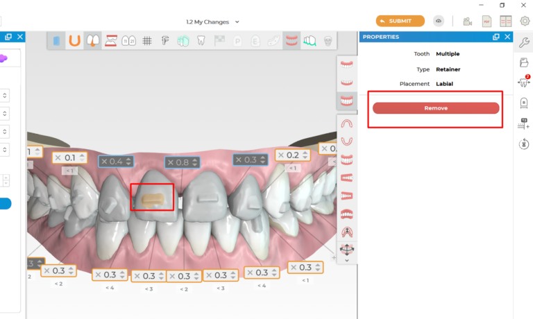 Ormco - Spark™ Releases - Latest Updates on Spark Aligners
