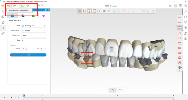 Ormco - Spark™ Releases - Latest Updates on Spark Aligners