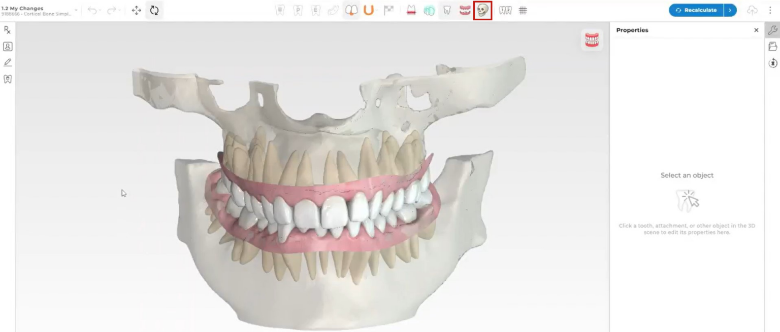 Ormco - Spark™ Releases - Latest Updates on Spark Aligners