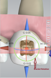 Ormco - Spark™ Releases - Latest Updates on Spark Aligners
