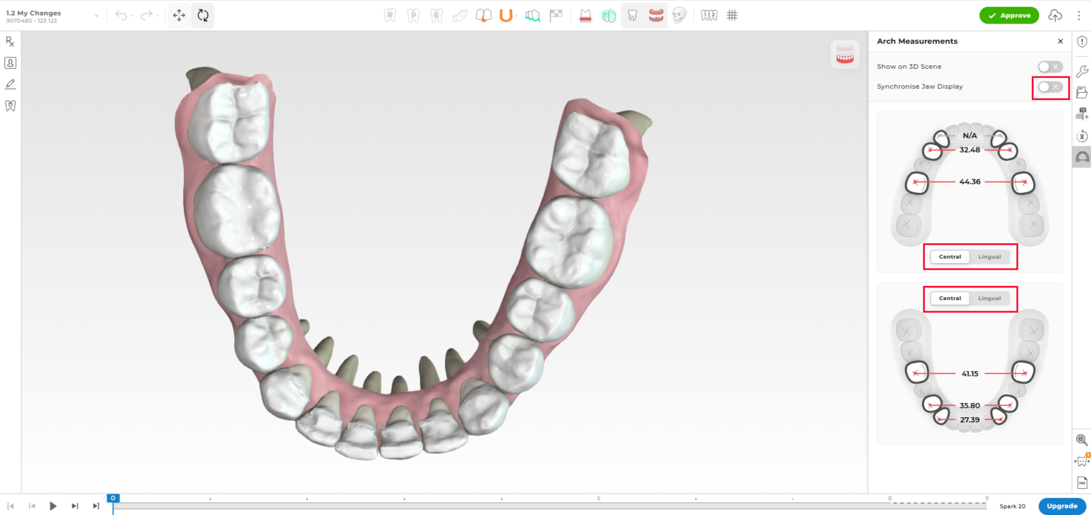 Ormco - Spark™ Releases - Latest Updates on Spark Aligners