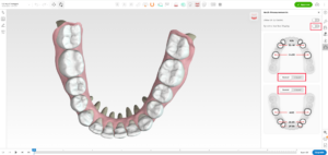 Ormco - Spark™ Releases - Latest Updates on Spark Aligners