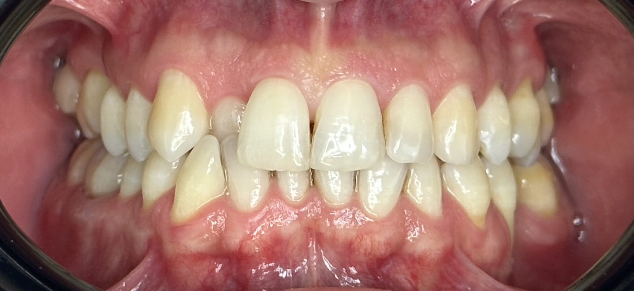 Precision and clarity in anterior crossbite correction with Spark ...
