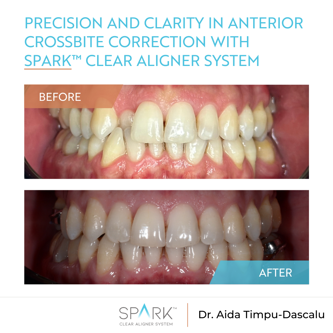 Precision and clarity in anterior crossbite correction with Spark ...