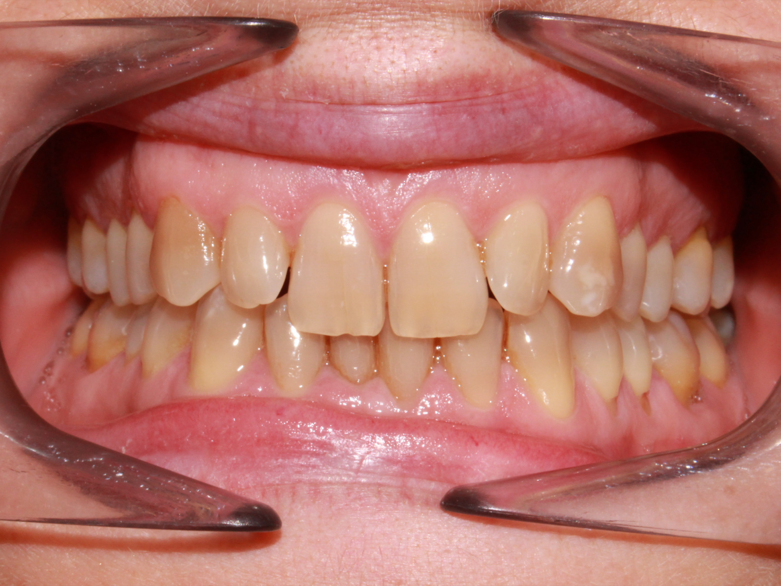 Spark-Treatment in adult patient with increased overbite, gummy smile ...