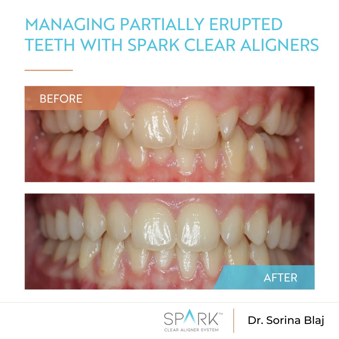 Managing partially erupted teeth with Spark Clear Aligners - Ormco