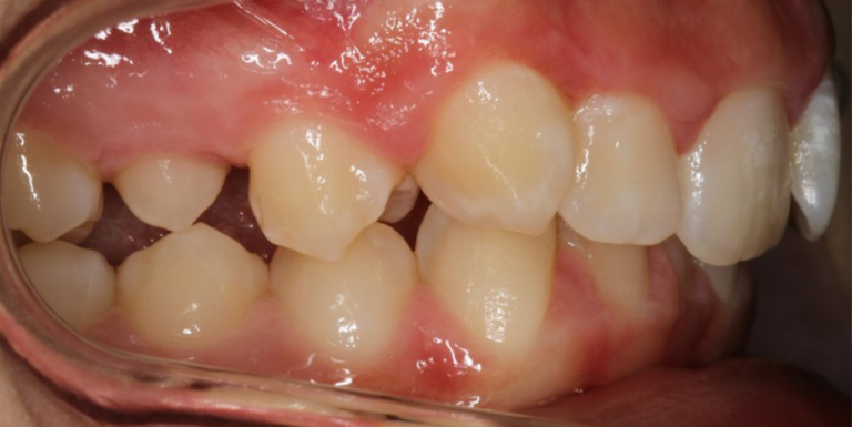 Gummy smile correction with Damon Ultima & VectorTAS - Ormco