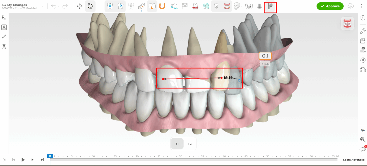 Ormco - Spark™ Releases - Latest Updates on Spark Aligners