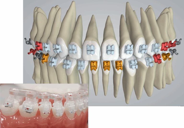 Ormco Digital Bonding - A Single Portal for Submitting Cases