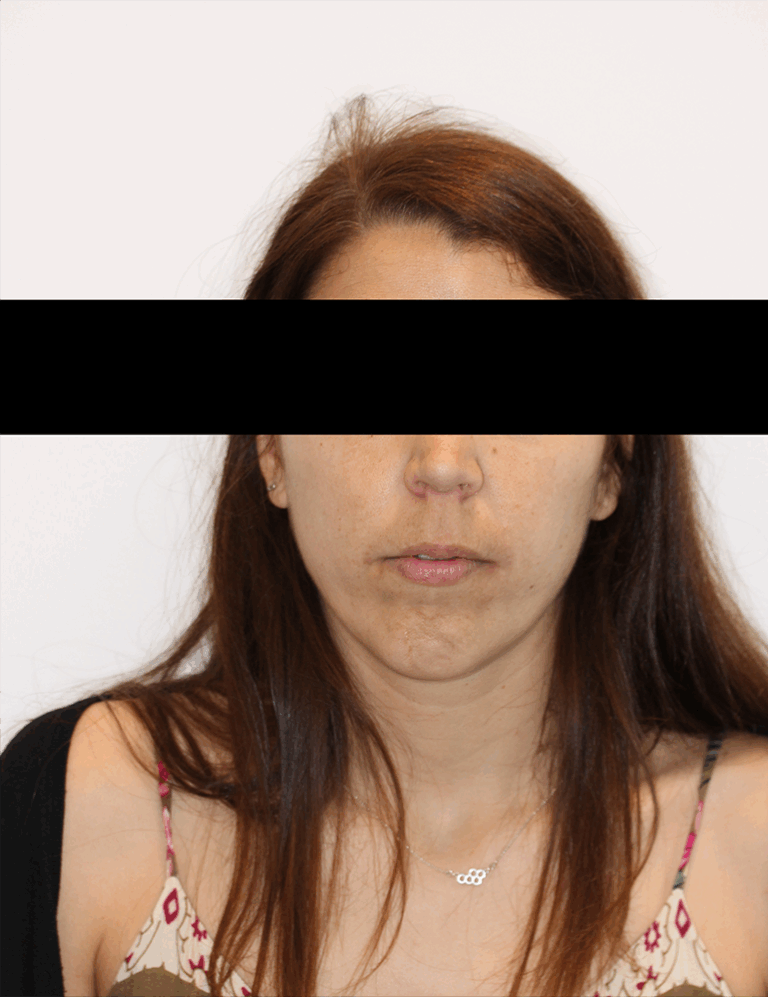 Aligners and temporary anchorage devices for the management of a Class ...