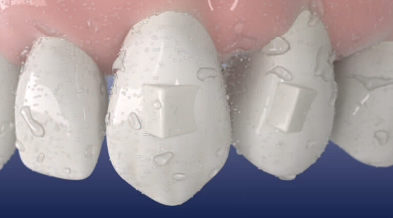 EtchFree white paper - Ormco
