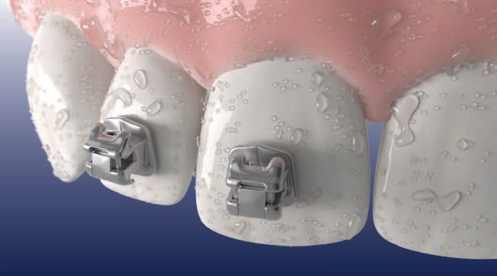 EtchFree white paper - Ormco